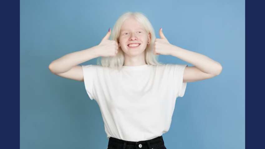 International Albinism Awareness Day 2023: छूआछूत का रोग नहीं है एल् ...