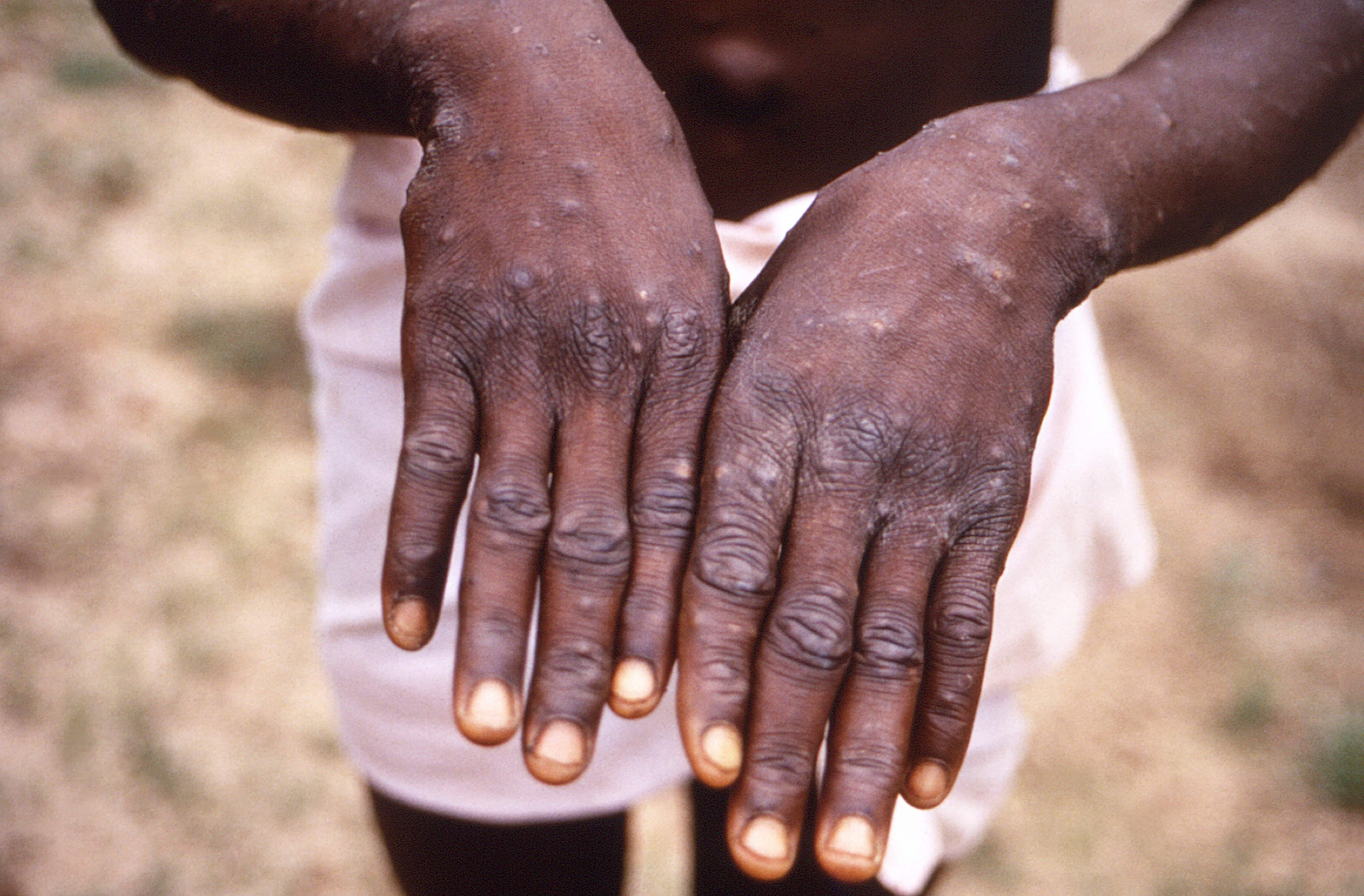 Monkeypox treatment and prevention: Dos and don'ts